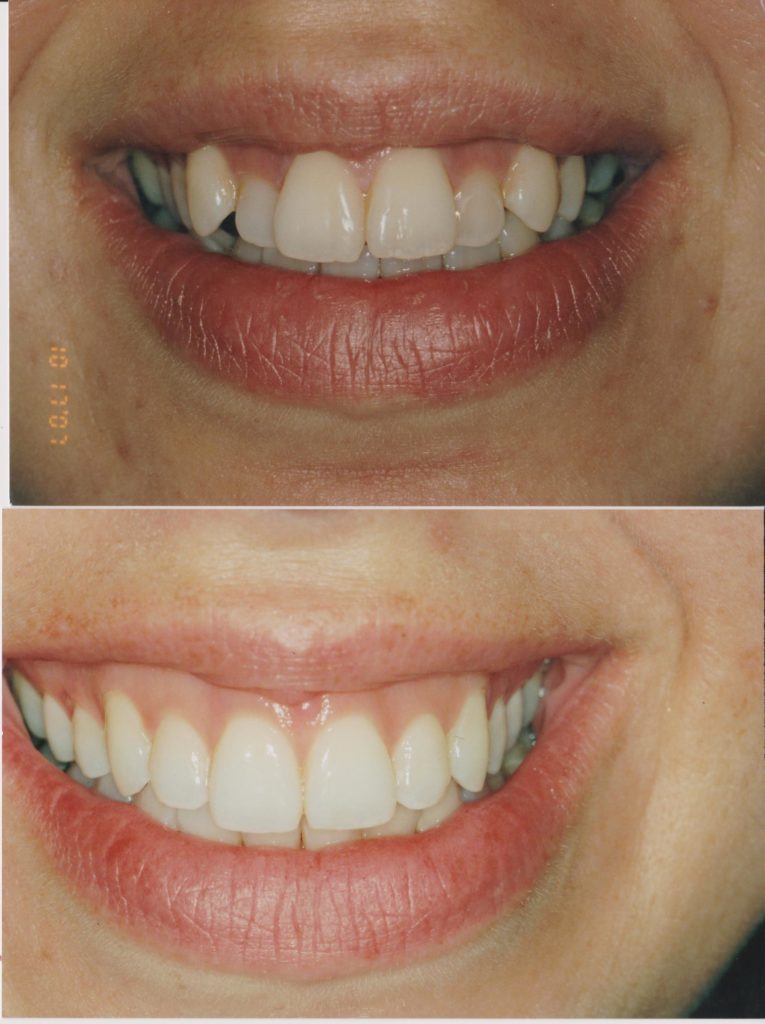 Invisalign Chicago, Lincoln Park, Lakeview - Get Invisible Clear Braces